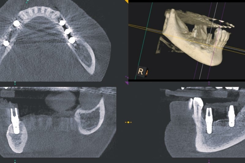 Augmentation in the mandible with maxgraft® bonebuilder - botiss ...