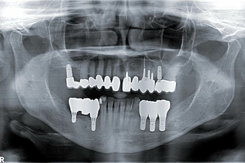 Augmentation in the mandible with maxgraft® bonebuilder - botiss ...