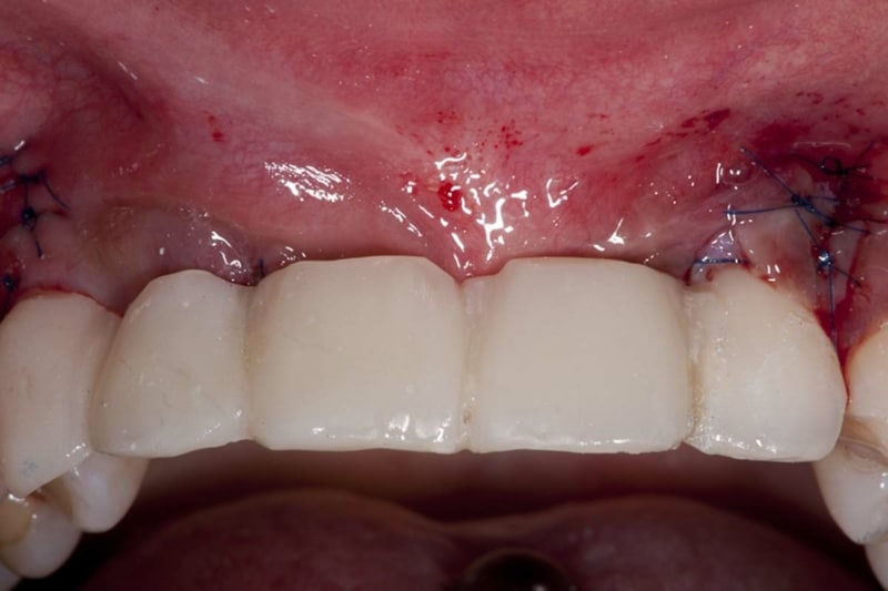 Block augmentation with maxgraft® block & mucoderm® - botiss ...