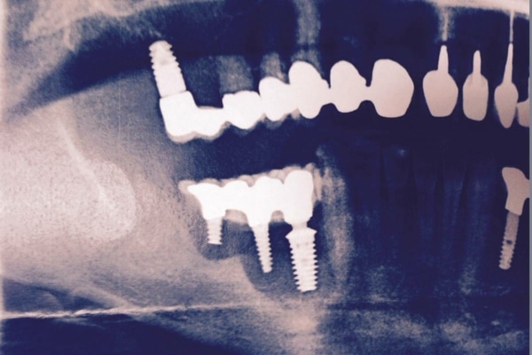 Augmentation in the mandible with maxgraft® bonebuilder - botiss ...
