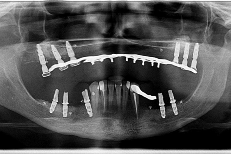 Vertical augmentation & sinus lift with maxgraft® bonering - botiss ...