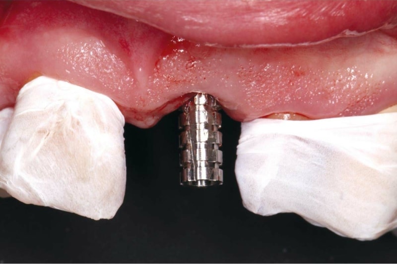 GBR using layering technique in aesthetic zone with maxgraft® and ...