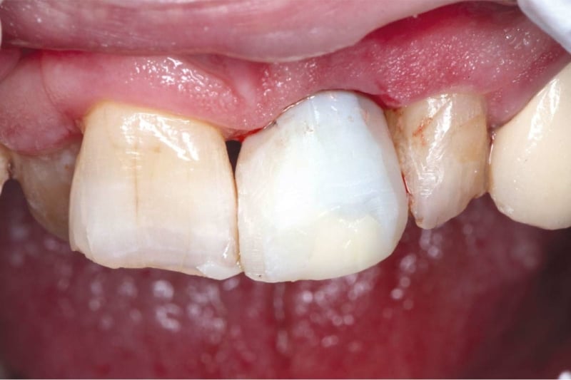 GBR using layering technique in aesthetic zone with maxgraft® and ...