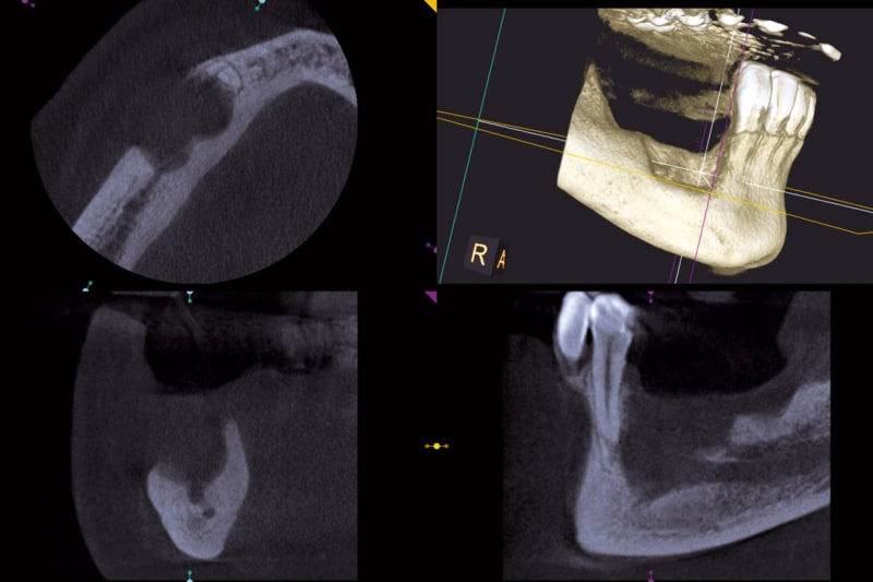 Augmentation in the mandible with maxgraft® bonebuilder - botiss ...