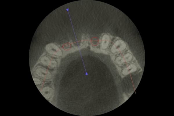 Block augmentation with maxgraft® block & mucoderm® - botiss ...