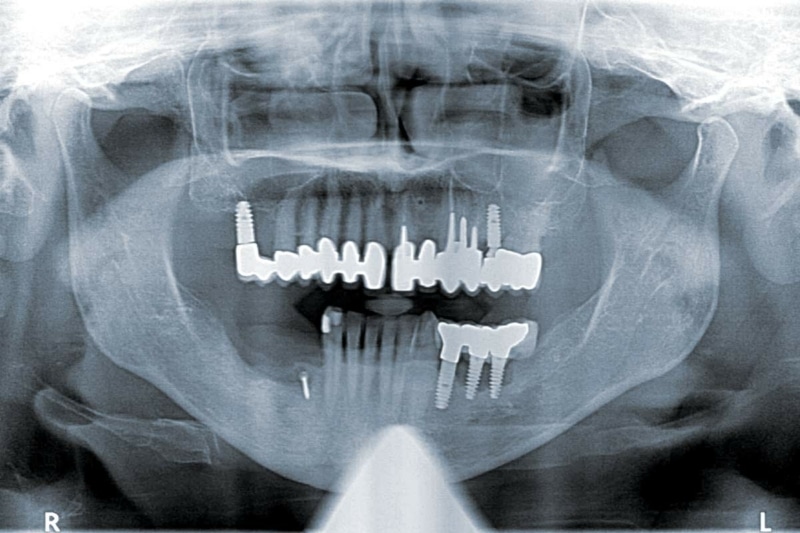 Augmentation in the mandible with maxgraft® bonebuilder - botiss ...