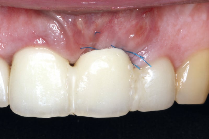 Socket augmentation using mucoderm®, maxgraft® and Straumann® Emdogain ...