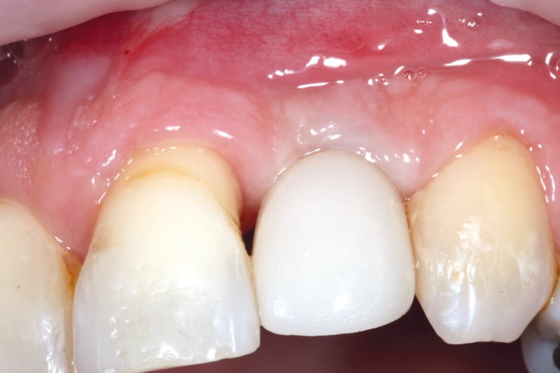 Restoration of single tooth gap in aesthetic zone with maxgraft ...