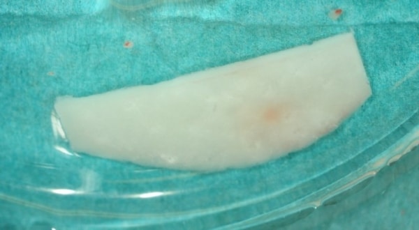 Widening of the peri-implant keratinized mucosa in the upper jaw with ...