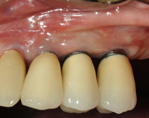 Widening of the peri-implant keratinized mucosa in the upper jaw with ...