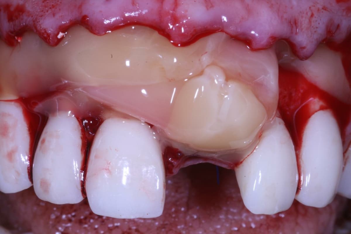 Treatment of an endo-perio-lesion and soft tissue augmentation with ...