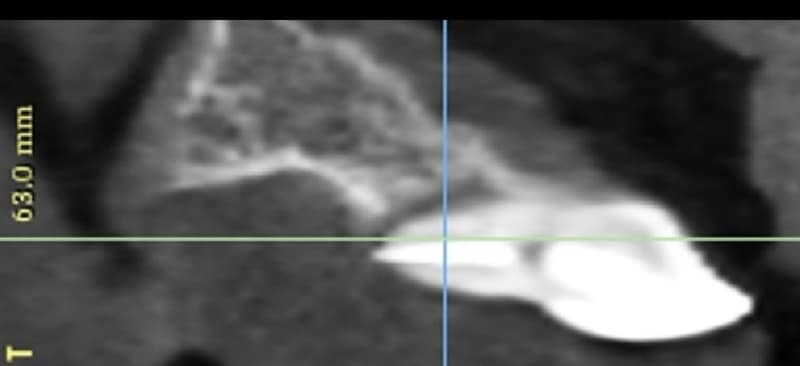 Treatment of an endo-perio-lesion and soft tissue augmentation with ...