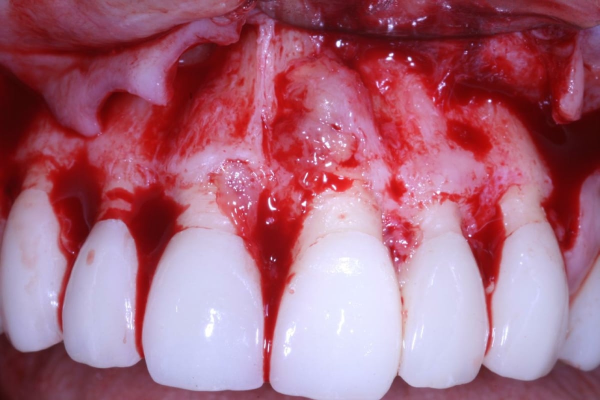 Treatment of an endo-perio-lesion and soft tissue augmentation with ...