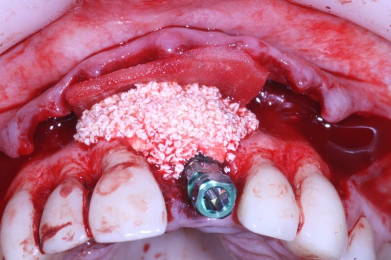 Treatment of an endo-perio-lesion and soft tissue augmentation with ...