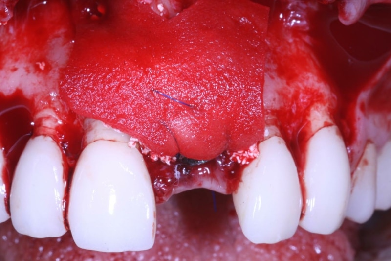 Treatment of an endo-perio-lesion and soft tissue augmentation with ...