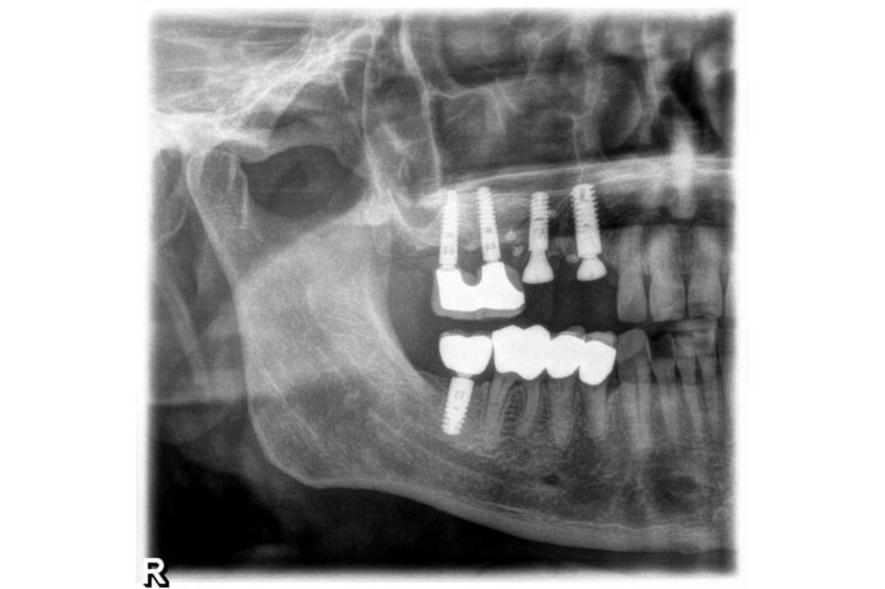 Periimplatitis treatment with maxgraft® bonering - botiss biomaterials GmbH