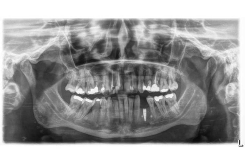 Augmentation of buccal and lingual bone lamella with maxgraft® bonering ...