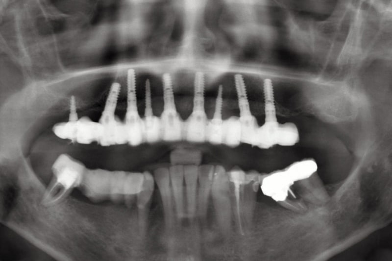 Horizontal ridge augmentation with maxgraft® cortico, cerabone® and ...