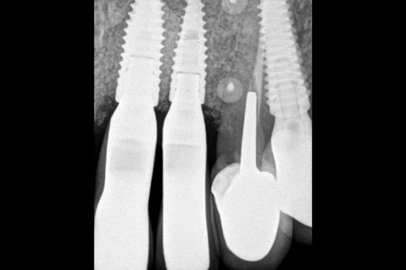 GBR with cerabone® and Jason® membrane using the Sausage Technique ...