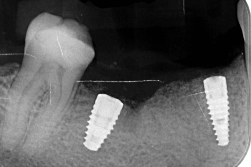 Vertical bone augmentation and broadening of attached gingiva using ...