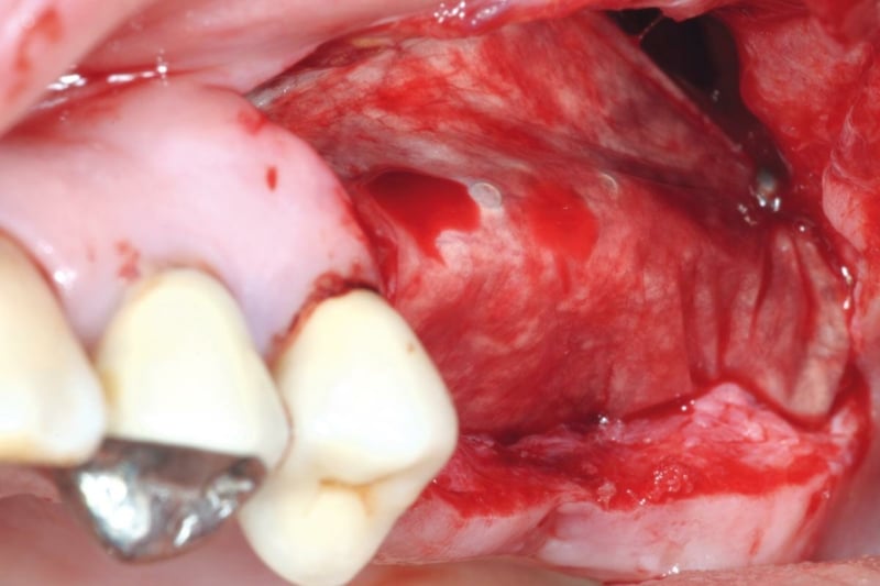 Treatment of a combined horizontal and vertical bone defect in the ...