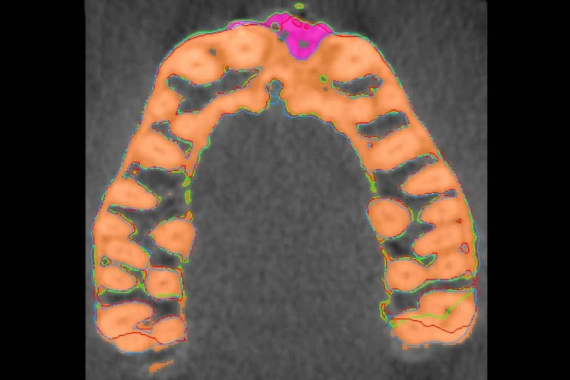 maxgraft® bonebuilder for alveolar reconstruction quantitated by a 3D ...