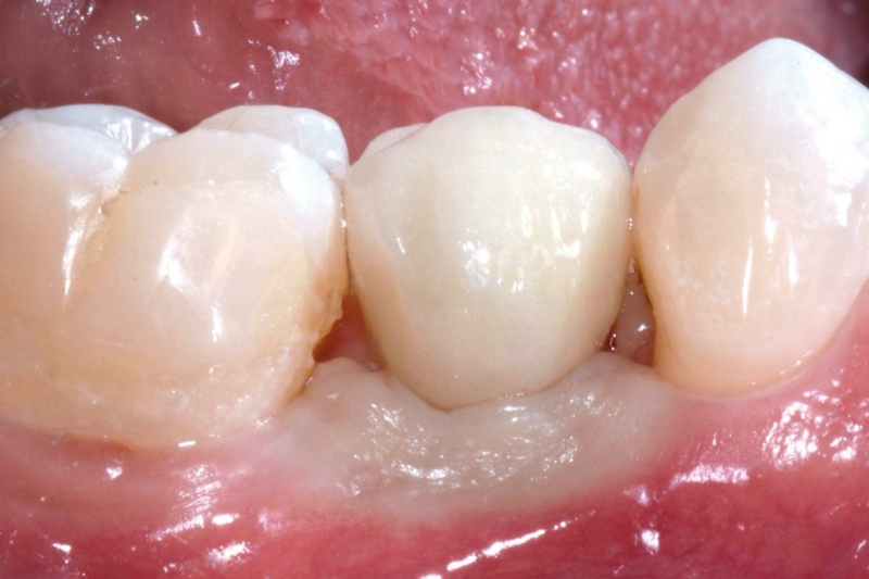 Application of mucoderm® in soft tissue management around single ...