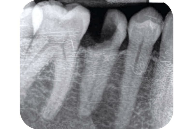Application of mucoderm® in soft tissue management around single ...