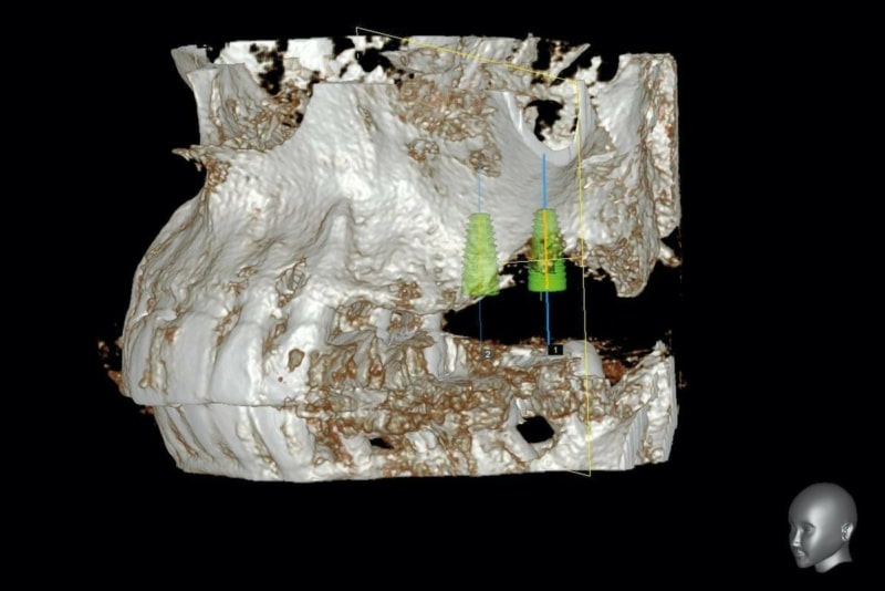 Treatment of a combined horizontal and vertical bone defect in the ...