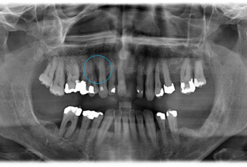 Non-contained intrabony defect treated using cerabone®, collprotect ...