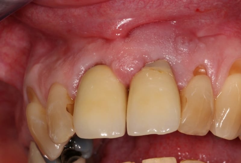 Restoration of single tooth gap in aesthetic zone with maxgraft ...