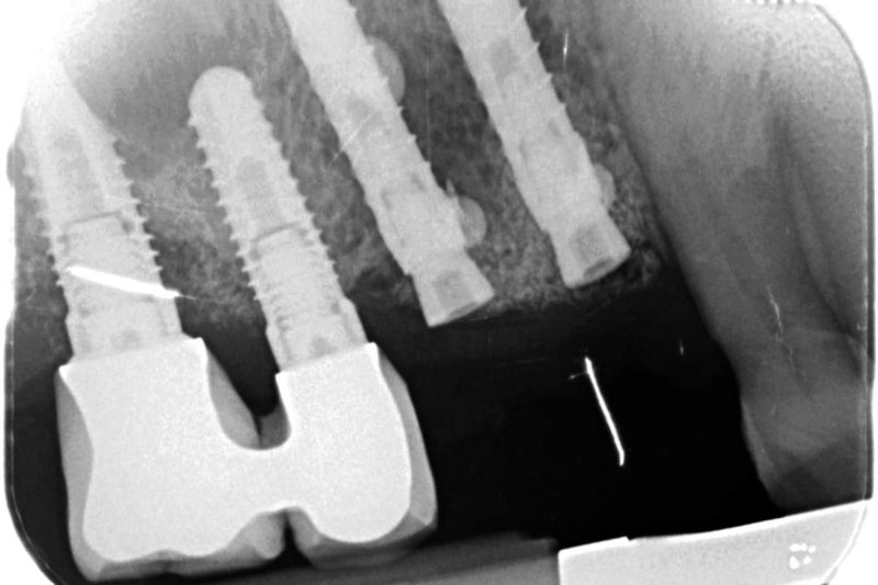 Implant placement and horizontal GBR in the posterior maxilla using ...
