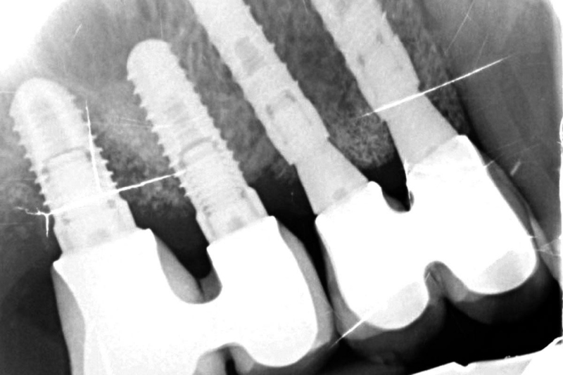 Implant placement and horizontal GBR in the posterior maxilla using ...