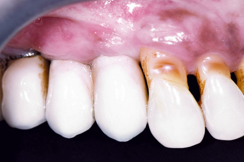 Implant placement and horizontal GBR in the posterior maxilla using ...
