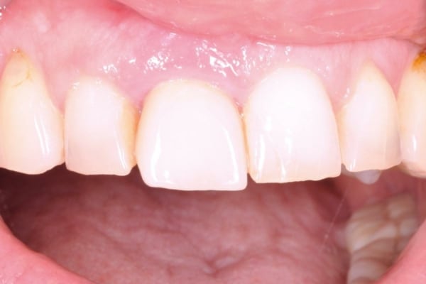 Tunneling approach using permamem® for socket preservation - botiss ...