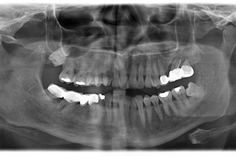Sinus lift two-stage with cerabone® and Jason® membrane - botiss ...