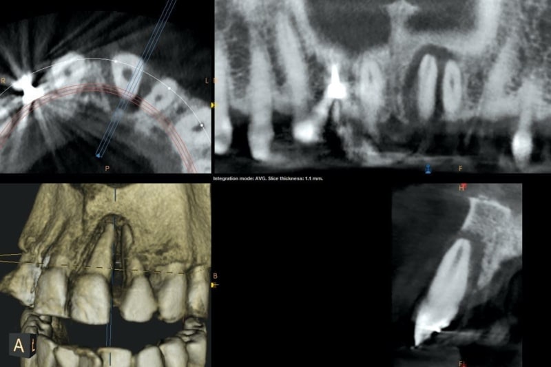 Implant placement and GBR in the aesthetic zone using cerabone® plus ...