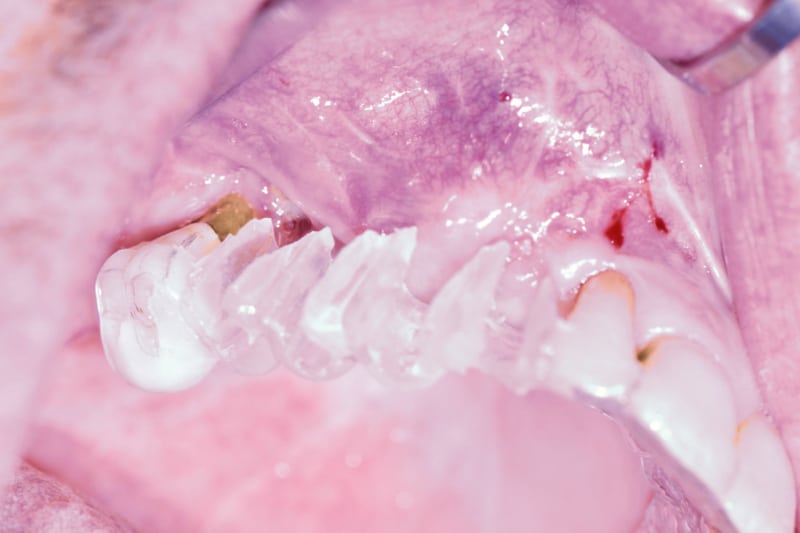 Ridge augmentation with maxgraft® bonebuilder and sinus floor elevation ...