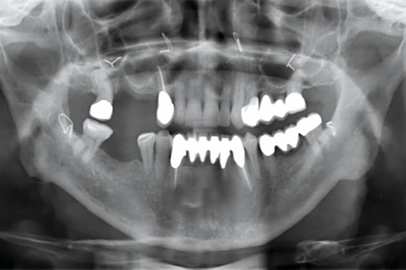 Ridge augmentation with maxgraft® bonebuilder and sinus floor elevation ...