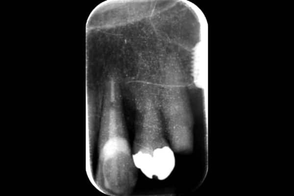 Treatment of combined horizontal and vertical intrabony defect using ...