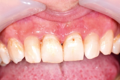 Treatment of multiple intrabony defects in the aesthetic area using ...