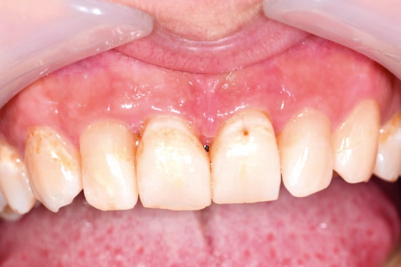 Treatment of multiple intrabony defects in the aesthetic area using ...