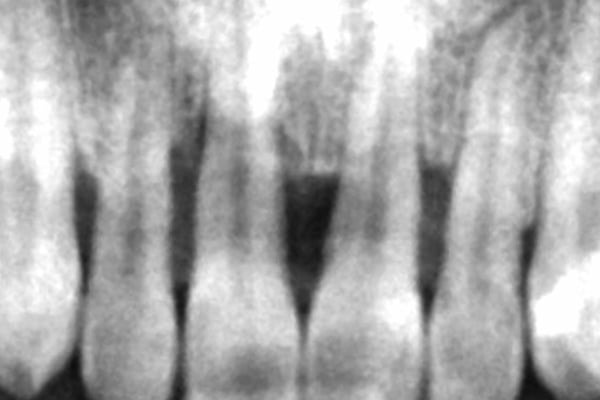 Treatment of multiple intrabony defects in the aesthetic area using ...