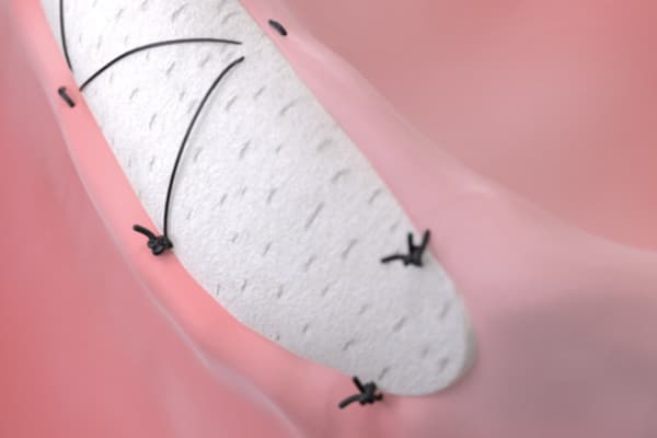 mucoderm® - botiss biomaterials GmbH